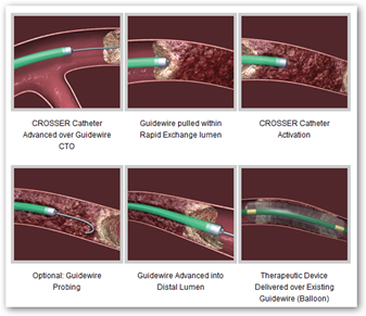 Medical Device Vibrates to Breaks Up Plaque in patients' clogged Leg ...